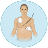 The Proper Placement Of Defib Pads: A Quick Guide